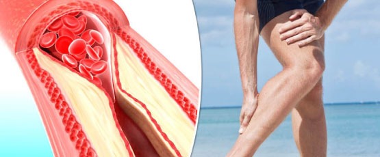 Chronic Venous Insufficiency Treatment Specialist - Vascular Health Center