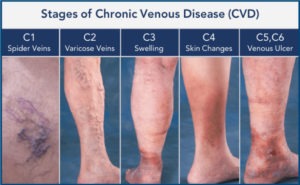 Chronic Venous Insufficiency Treatment Specialist - Vascular Health Center