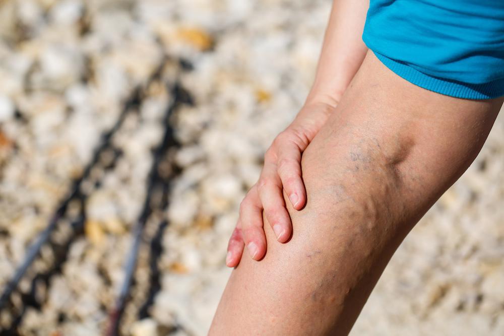 What Is Chronic Venous Insufficiency Vascular Health Center What Is Chronic Venous Insufficiency Vascular Health Center
