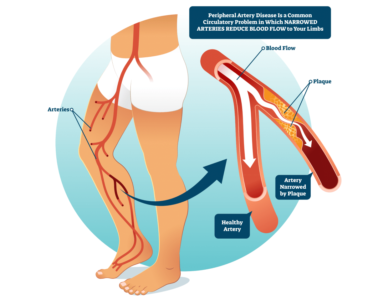 PAD LP - Vascular Health Center